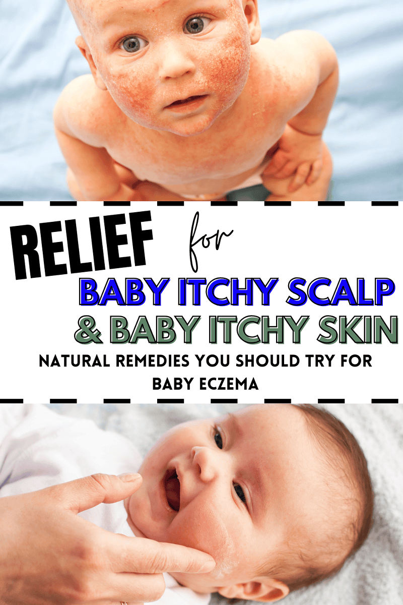 12 Baby Eczema Natural Remedies To Try | Bump To Busy Mama