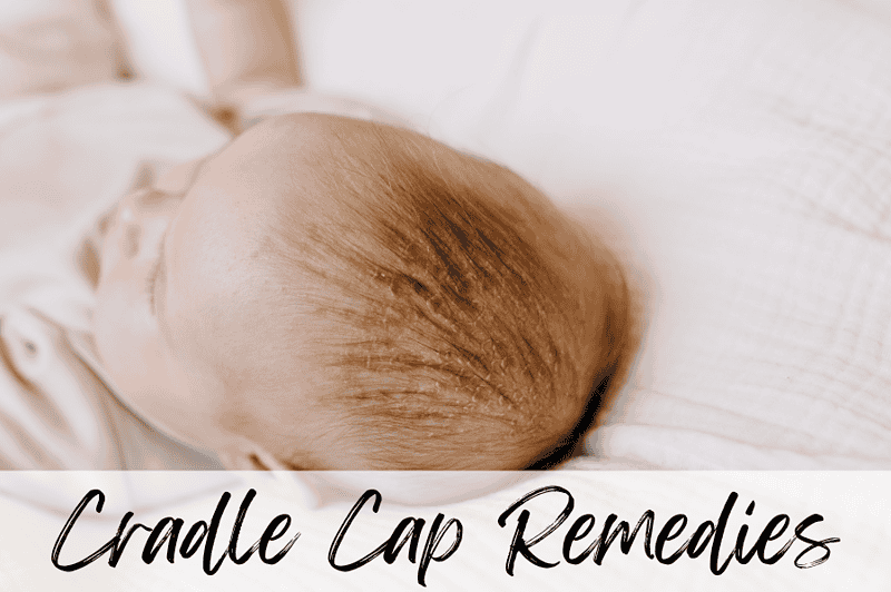 Looking For Cradle Cap Remedies? Here's What Actually Works! | Bump To ...